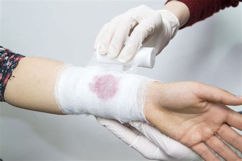Internal And External Bleeding Emergencies Coast2coast