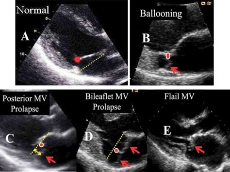 Echocardiographic Evaluation Of Mitral Valve Disease Mitral Regurgit