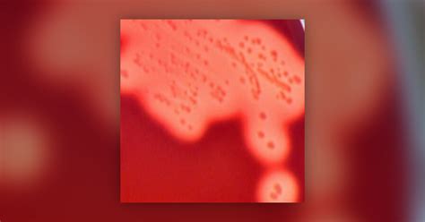 Record Number Of Invasive Strep A Infections Reported In Canada Am