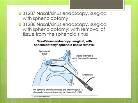 Maxillary Sinus Endoscopy