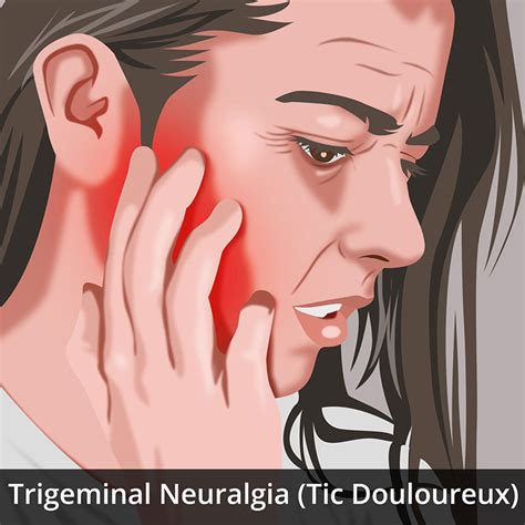 Headache Map Migraine Advances