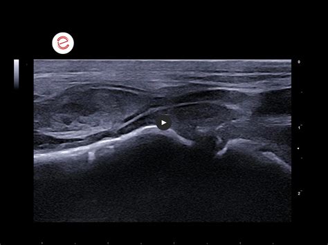 Synovial Sarcoma Esaote