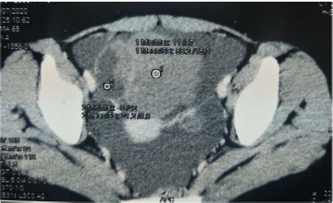Abdominal Ct Showing Fluid In The Peritoneal Cavity Without Evidence Of