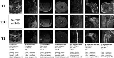 Deep Learning For Classification Of Bone Lesions On Routine Mri