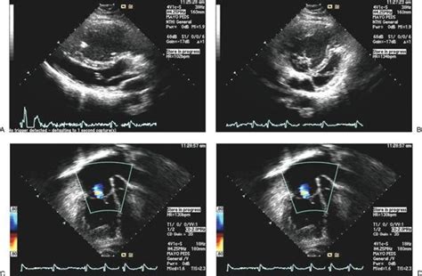 Evaluation Of The Adult With Transposition After Atrial Or Arterial Switch Operations Thoracic Key
