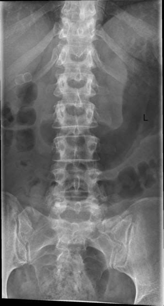 Cholelithiasis Cholelithiasis Radiology Gallstones