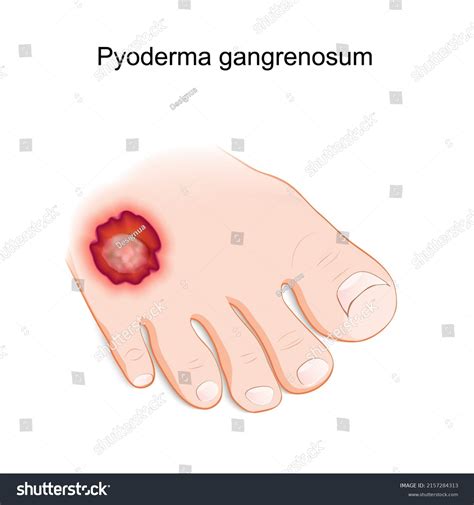 Pyoderma Gangrenosum Over 9 Royalty Free Licensable Stock Vectors