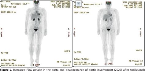 Figure 2 From What Is Isolated Idiopathic Non Syndromic Aortitis