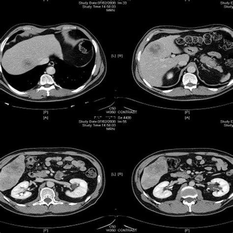 Computed Tomography Scan Of The Submandibular Space Showing The