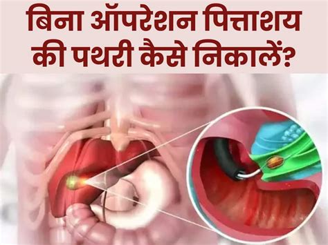 Pitt Ki Thaili Ki Pathri Ka Gharelu Upay पित्त की थैली में पथरी होने