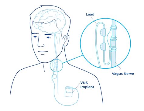 Stroke Vagus Nerve Stimulation VNS Rehabilitation WakeMed