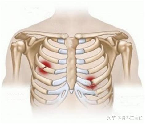 肋骨疼痛是骨折和还是肌肉拉伤感觉有什么不一样 知乎