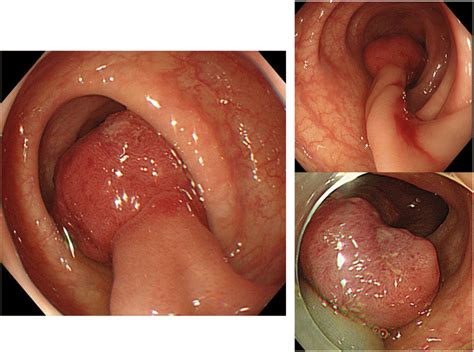 Colonoscopic Findings A 20 Mm Pedunculated Polyp Is Present In The