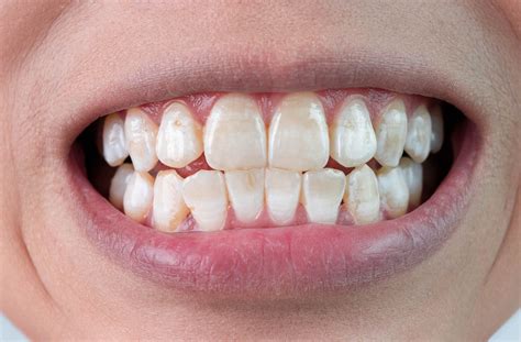 White Spots On Teeth Causes Treatment Prevention Bilarasa