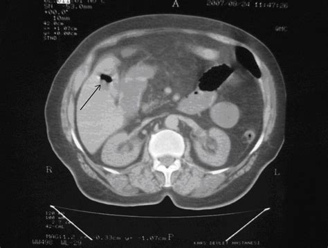 Gas Collection In The Gallbladder Fossa Download Scientific Diagram