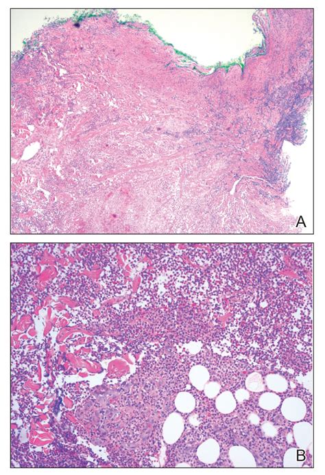 Pyoderma Gangrenosum Histology