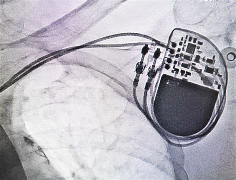 Portable Defibrillator For Hearth Editorial Photography Image Of
