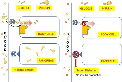 Understanding Iddm What You Need To Know About Insulin Dependent