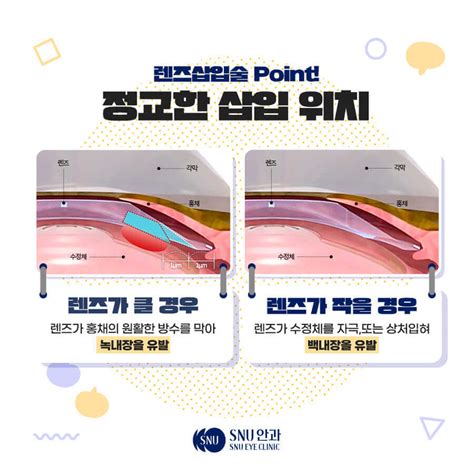 Icl 렌즈삽입술 검사 수술과정 그리고 회복기간 2025 모두닥