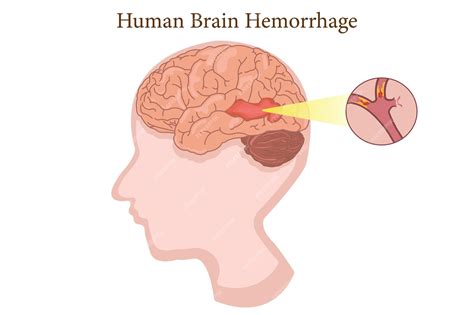 Premium Vector Human Anatomy Disease Stroke Vector Illustration On