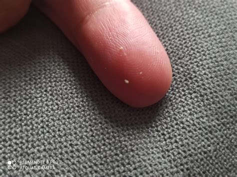 Are These Bed Bug Eggs Rbedbugs