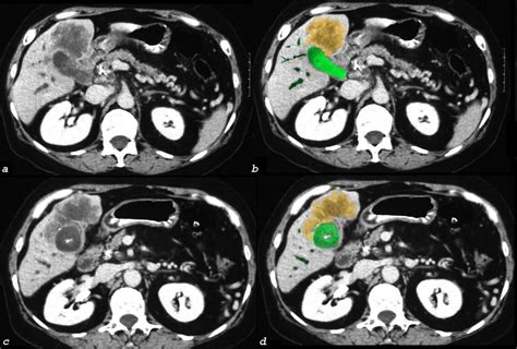 Gallbladder Fossa The Common Vein