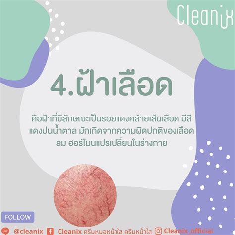 Cleanix วันนี้แอดมินจะพาไปรู้จักชนิดของฝ้าและวิธีรักษาค่ะ