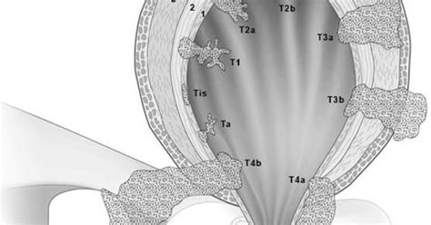 Tnm And Figo Staging Of Ovarian Carcinoma Simplified Epomedicine