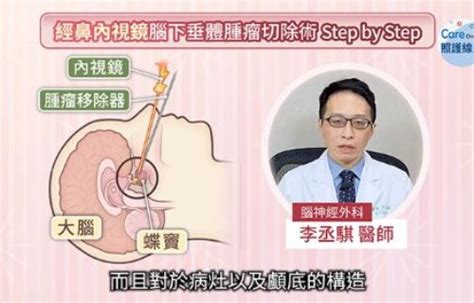 腦下垂體腫瘤警訊與經鼻內視鏡腦下垂體腫瘤切除手術｜照護線上 媽咪拜mamibuy