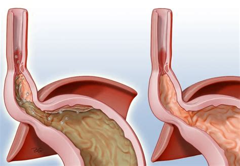 What Size Hiatal Hernia Needs Surgery