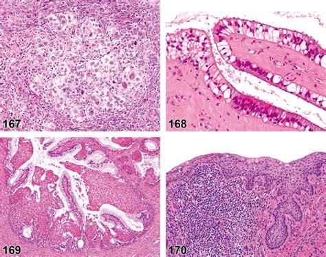 Cynomolgus Uterus Choriocarcinoma Hande High Magnification Figure