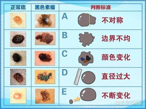黑色素瘤该怎么辨别 知乎