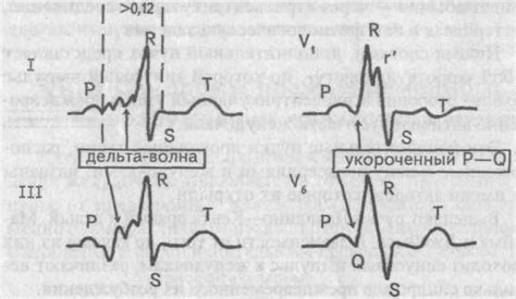 Синдром Клерка Леви Кристеско синдром Clc — Cardiowiki