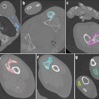 Representative Mm Axial Slices From A CT Scan Showing HO Download Scientific Diagram