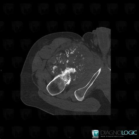 Radiology Case Chondrosarcoma CT Diagnologic