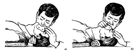 1 5 Искусственное дыхание