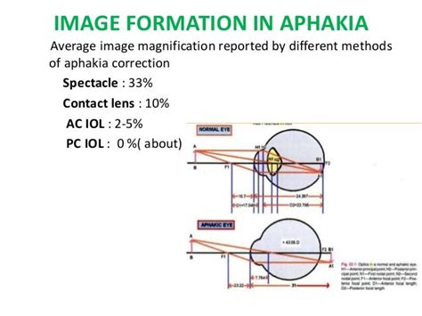 Aphakia By Suraj Chhetri
