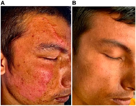 A A Large Erythematous Plaque Over Right Face B Complete