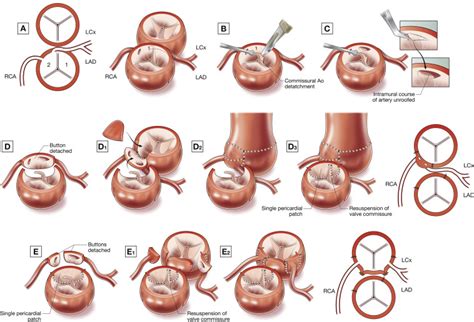 Excellent Long Term Outcomes Of The Arterial Switch Operation In