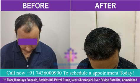 Best Natural Looking Hair Transplant Results Of 2020 9 Months After