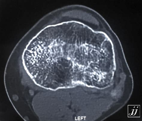 Msk Proximal Tibia Fracture And Infection 26 Radioogle