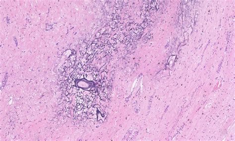 Pathology Outlines Cardiac Myxoma