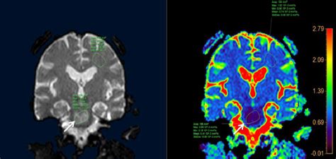 Image Findings Show An Infarction Lesion Of Pons White Arrow With Download Scientific Diagram