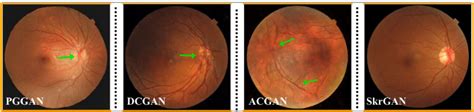 Synthesized Retinal Images By Pggan 7 Dcgan 14 Acgan 11 And Our