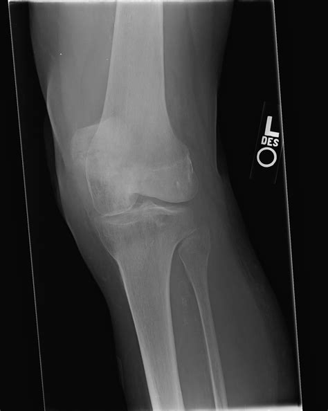 Patella Fracture Buyxraysonline