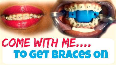 GETTING BRACES VLOG 2015 YouTube