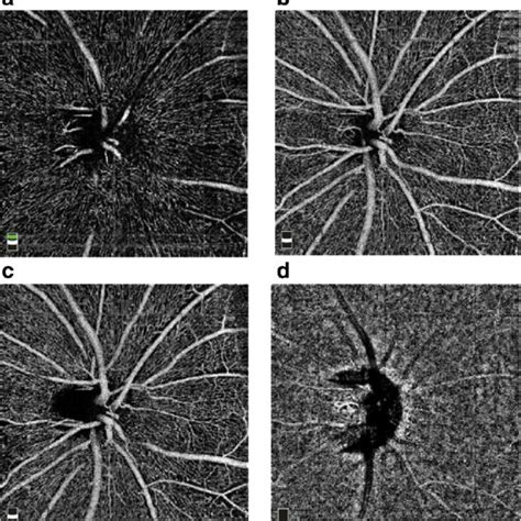 Macular Image Segmentation A Superficial Retina Capillary Plexus B