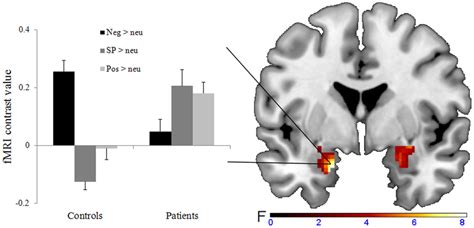Region Of Interest Analysis Of The Amygdala Left Bar Graphs Depicting