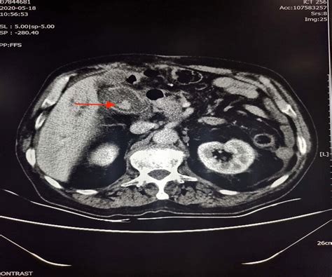 Abdominal Ct Enlarged Gallbladder Thickened Wall And Circular