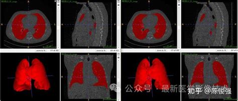 Vessel2012——肺血管分割 知乎